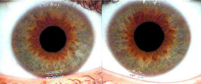 Human Pupil Color and Dimensions - Clinical Neuro-Optic Reseach Institute