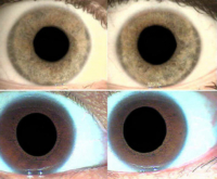 Human Pupil Mydriasis - Clinical Neuro-Optic Reseach Institute