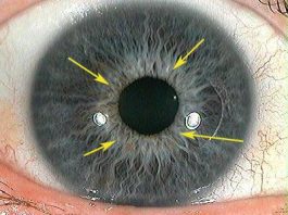 The Collarette | Clinical Neuro-Optic Reseach Initiative